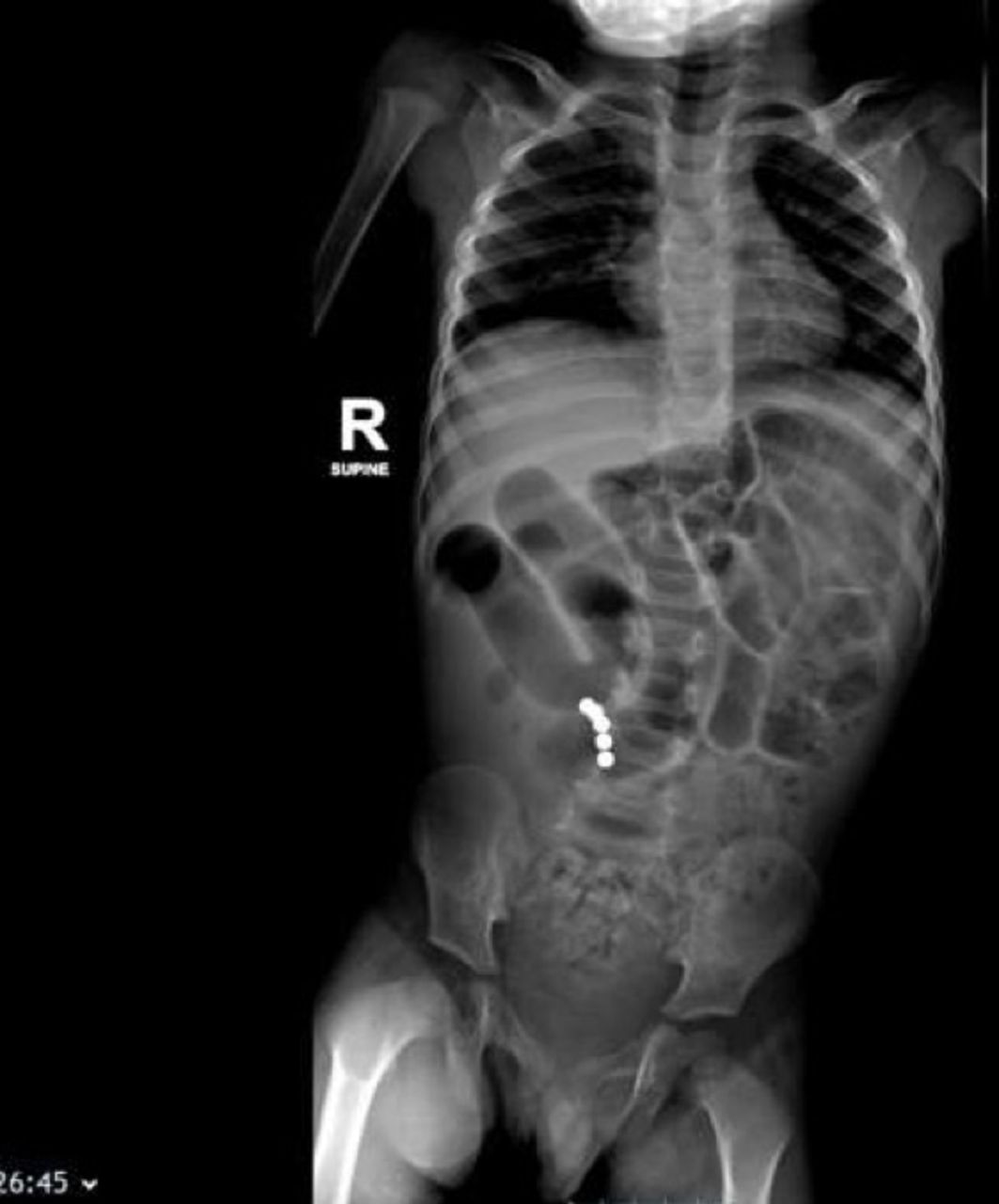 Volvulus X Ray Neonate